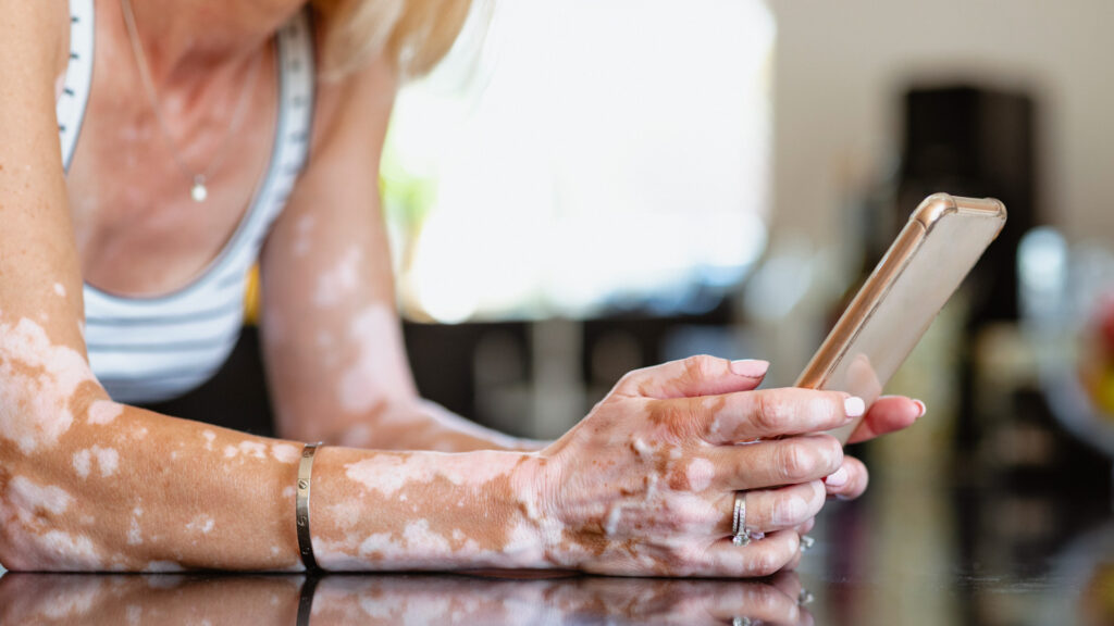Día Mundial del Vitiligo: qué es, a quiénes afecta y cómo se trata