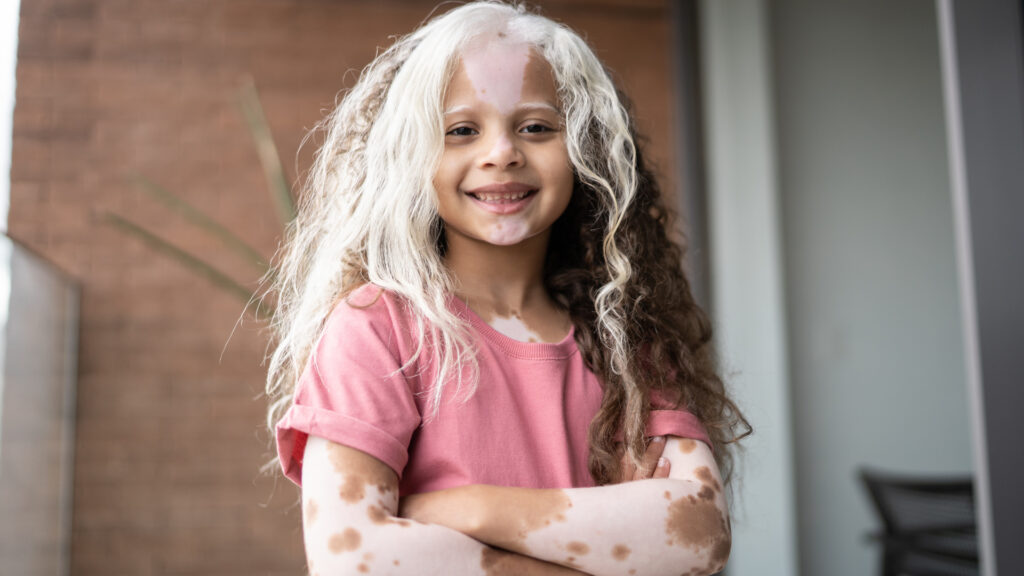 Día Mundial del Vitiligo: qué es, a quiénes afecta y cómo se trata