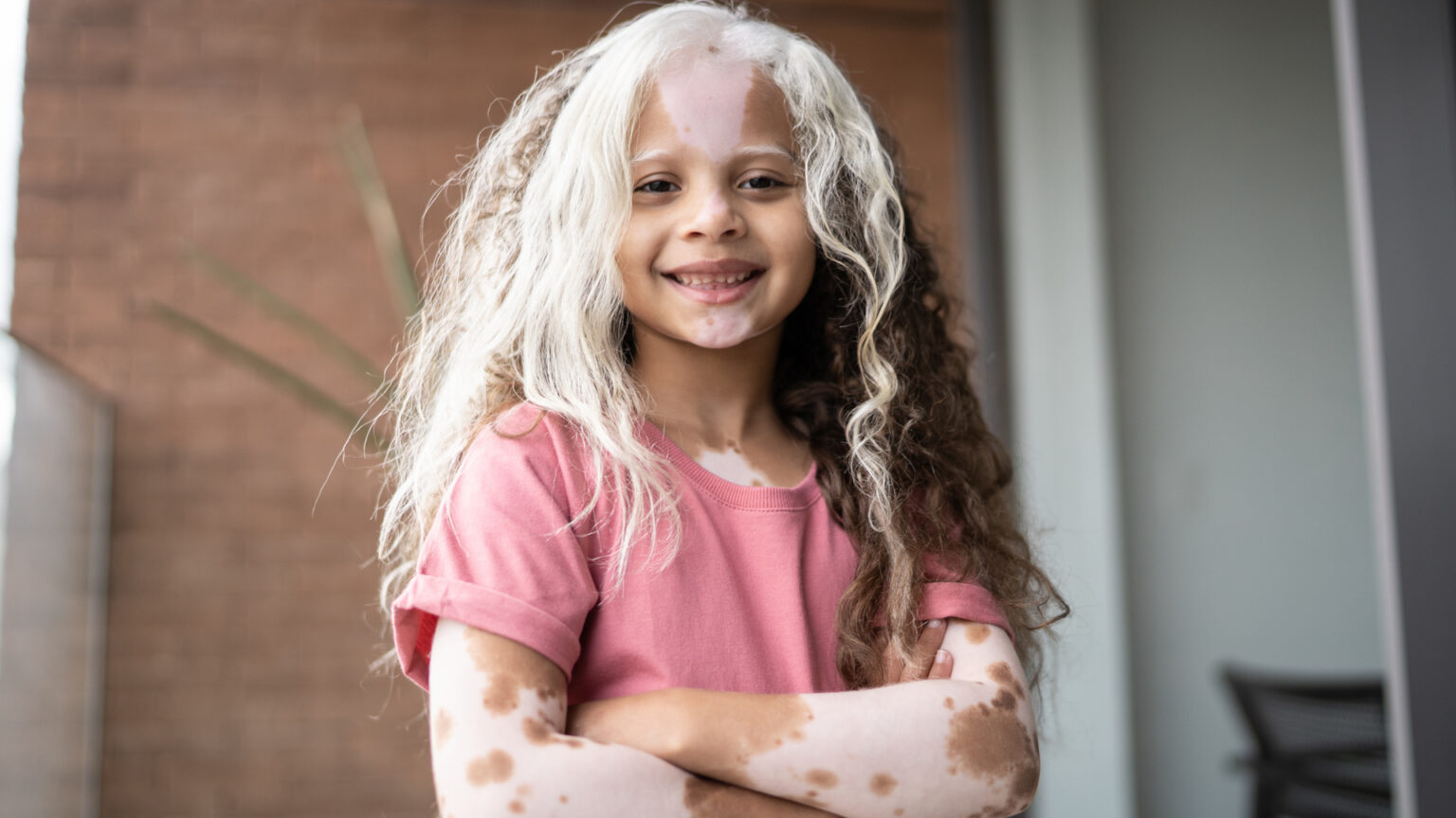 Día Mundial del Vitiligo: qué es, a quiénes afecta y cómo se trata