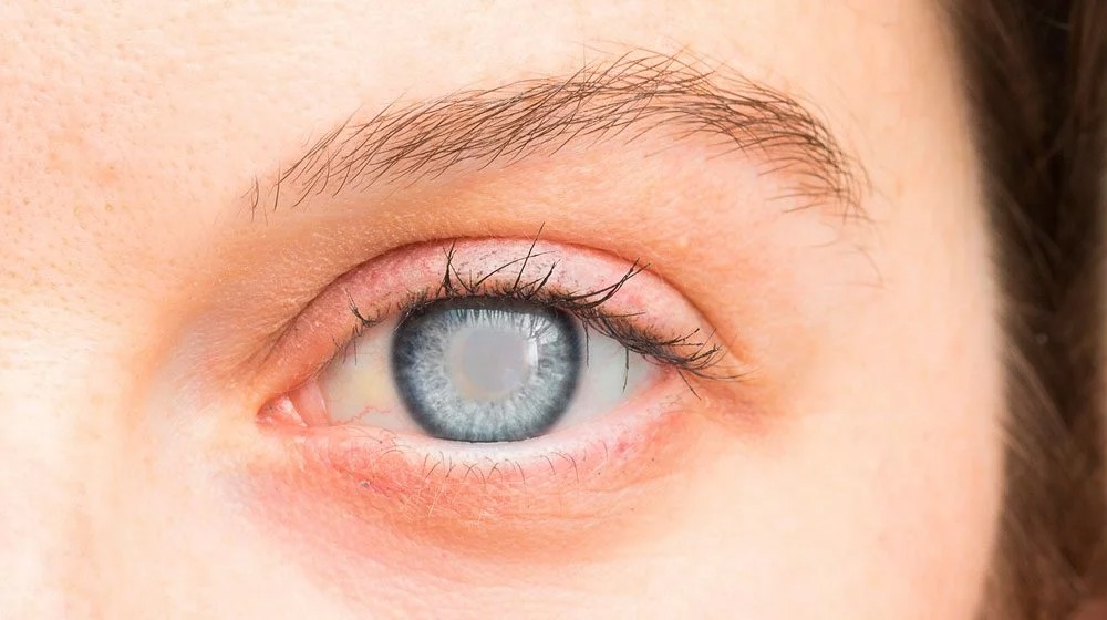 Día Mundial del Glaucoma: La enfermedad silenciosa